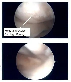 Subchondroplasty - Complete Orthopedics & Podiatry | Multiple NY Locations