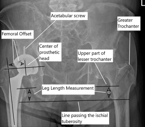 Leg Length Discrepancy After Hip Replacement | Complete Orthopedics
