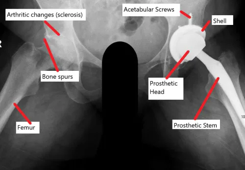 Hip or Leg Swelling after Replacement Surgery | Complete Orthopedics